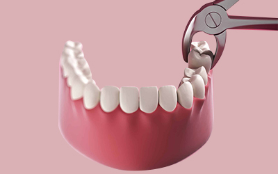 Best tooth removal treatment in kondapur, Hyderabad - Tooth Matters